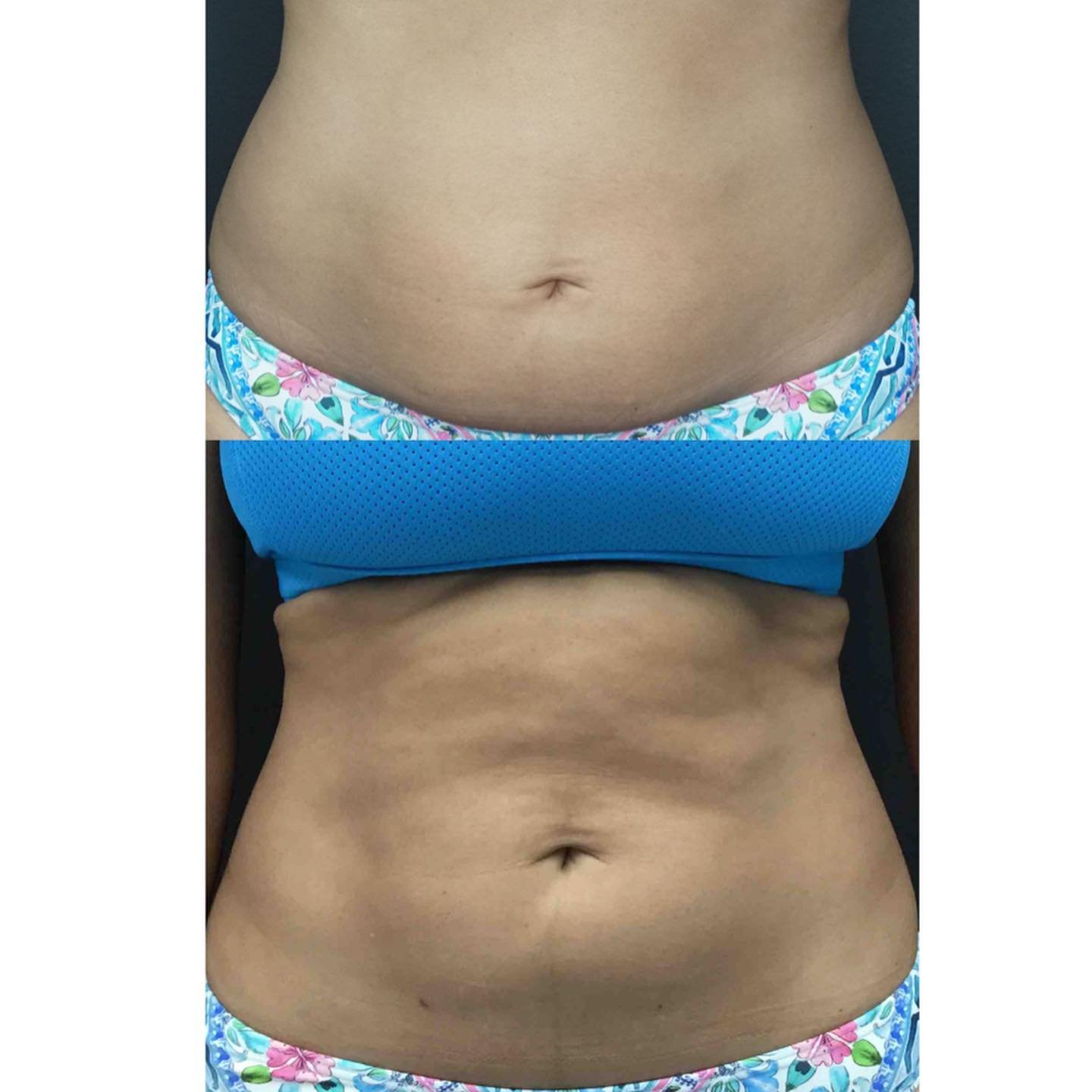 CoolSculpting - A Fine Line Aesthetics